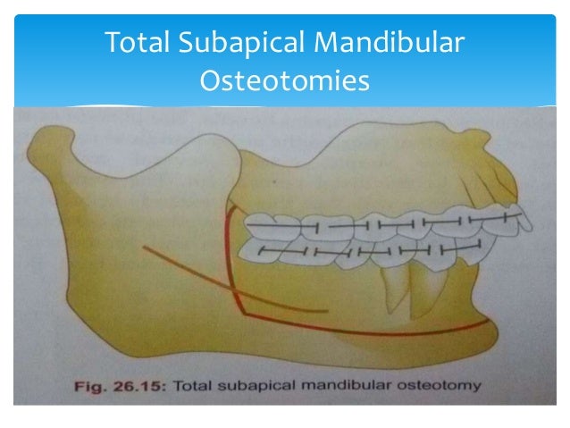 Pre-Surgical procedures in orthognathic surgeries of mandible.