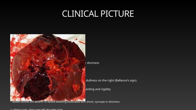 SURGERY.ppt.SPLEEN INJURY HAS MADE EASY IN SLIDES | PPT