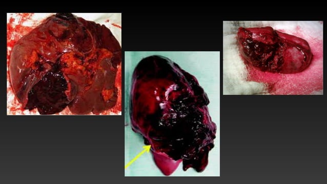 SURGERY.ppt.SPLEEN INJURY HAS MADE EASY IN SLIDES | PPT