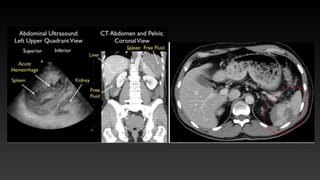 SURGERY.ppt.SPLEEN INJURY HAS MADE EASY IN SLIDES | PPT