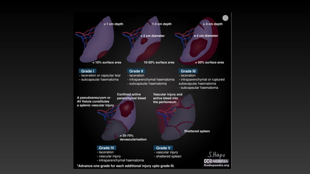 SURGERY.ppt.SPLEEN INJURY HAS MADE EASY IN SLIDES | PPT