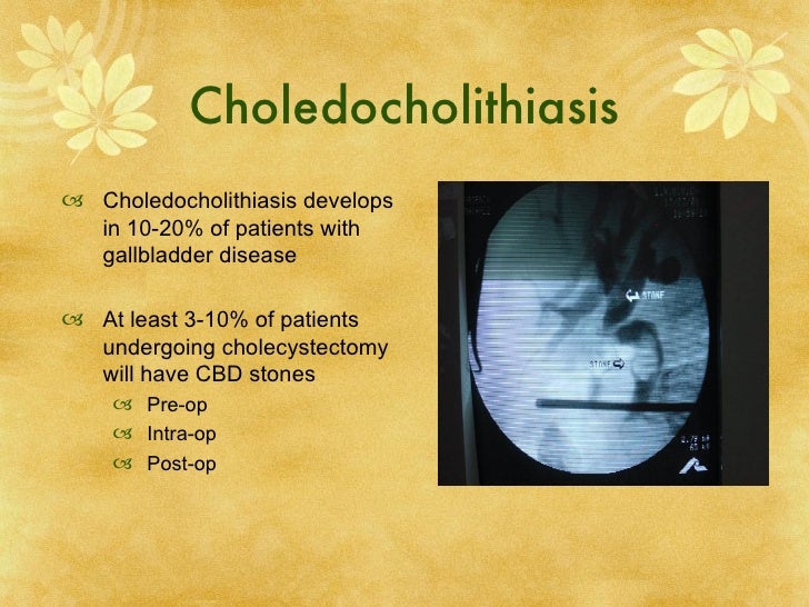 Choledocholithiasis Ercp