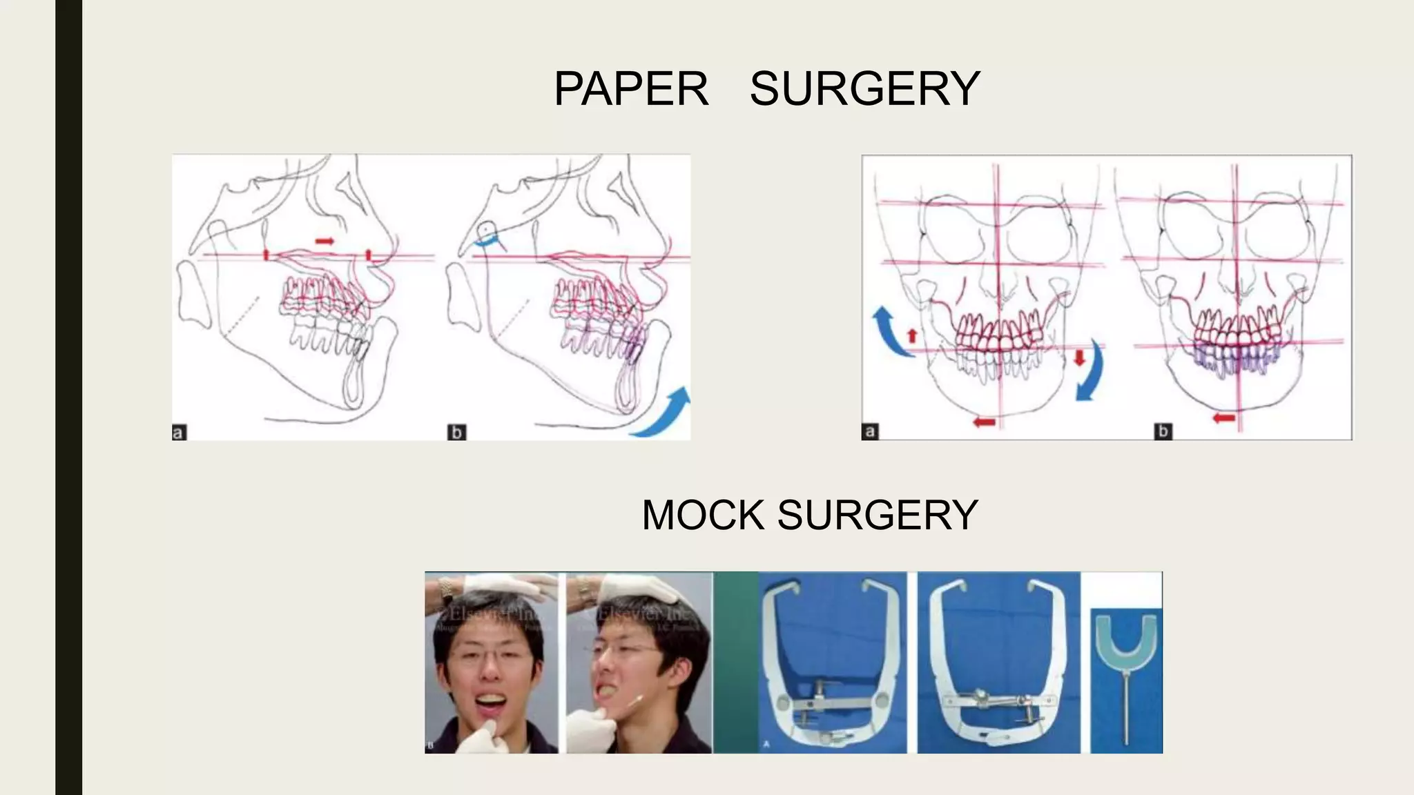 Surgery first orthognathic approach | PPTX