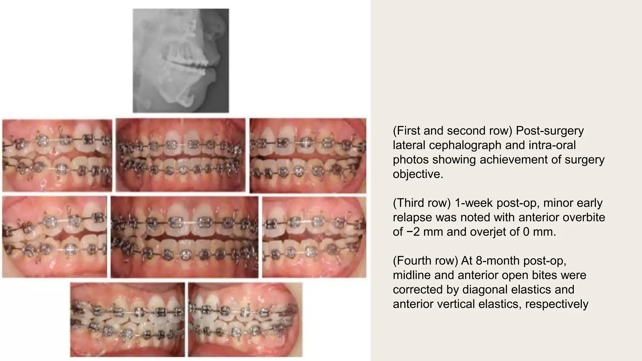 Surgery first orthognathic approach | PPTX