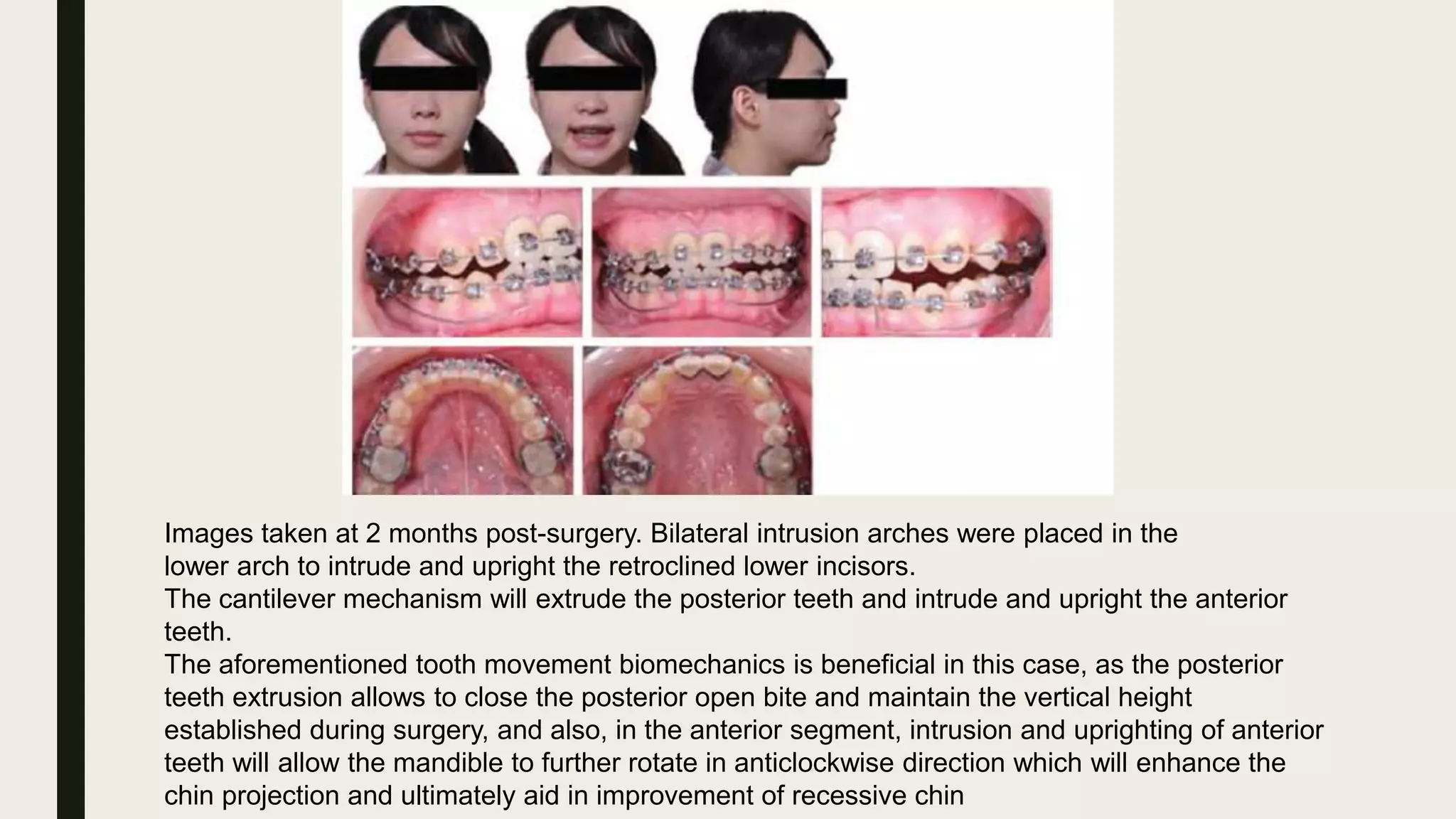 Surgery first orthognathic approach | PPTX