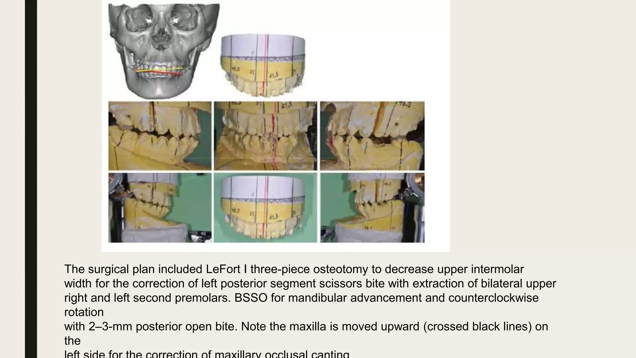 Surgery first orthognathic approach | PPTX