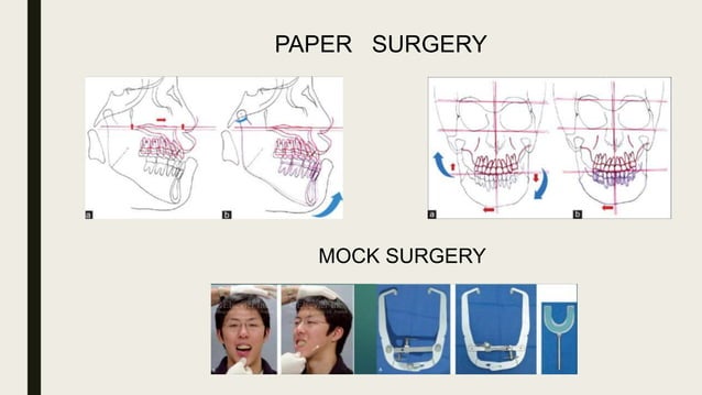 Surgery First Orthognathic Approach Pptx Bone And Joint Conditions