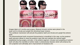 Surgery first orthognathic approach | PPTX