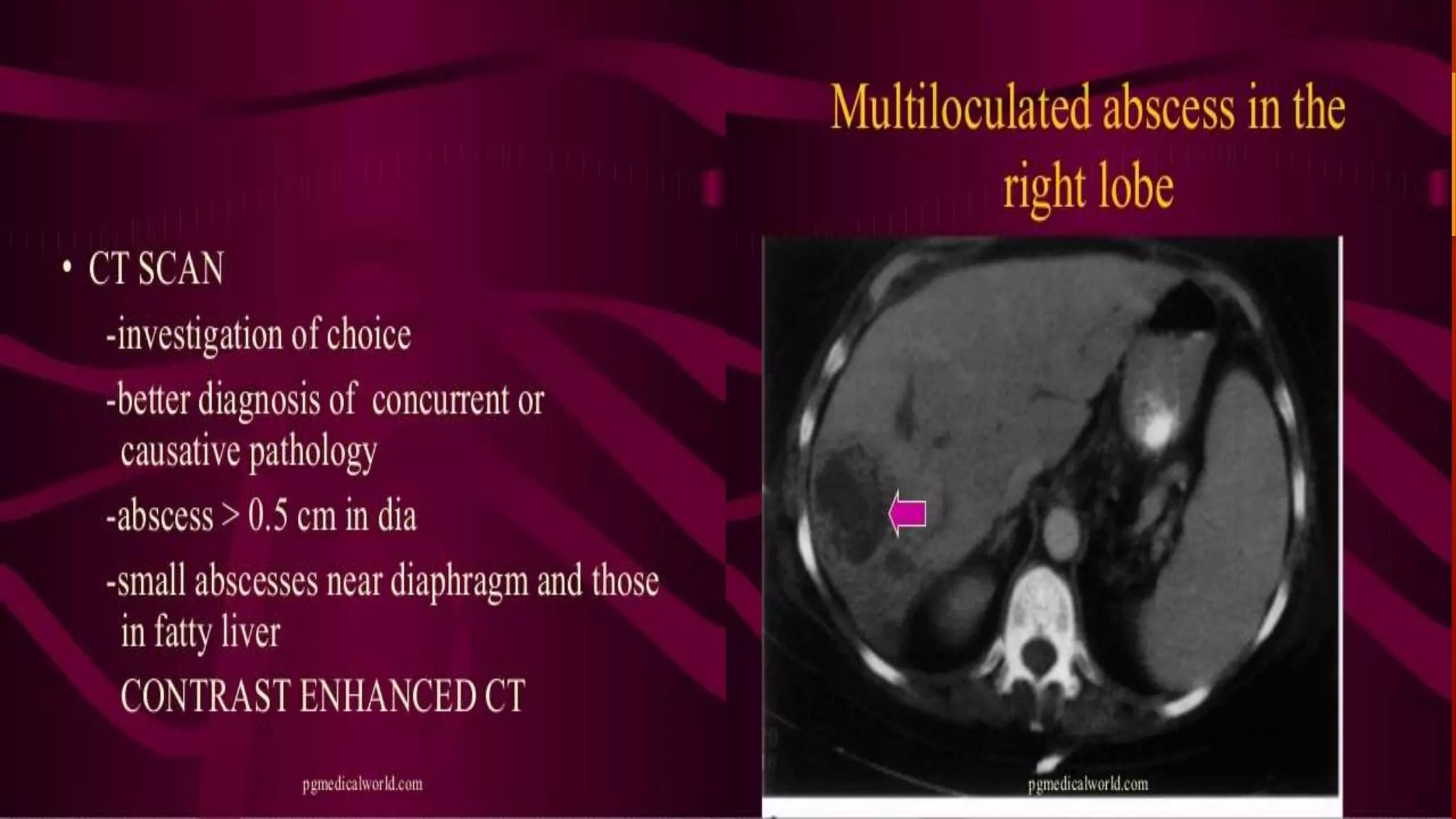 DIFFERENTIAL DIAGNOSIS OF SWELLINGS IN THE RIGHT HYPOCHONDRIUM AND ITS ...