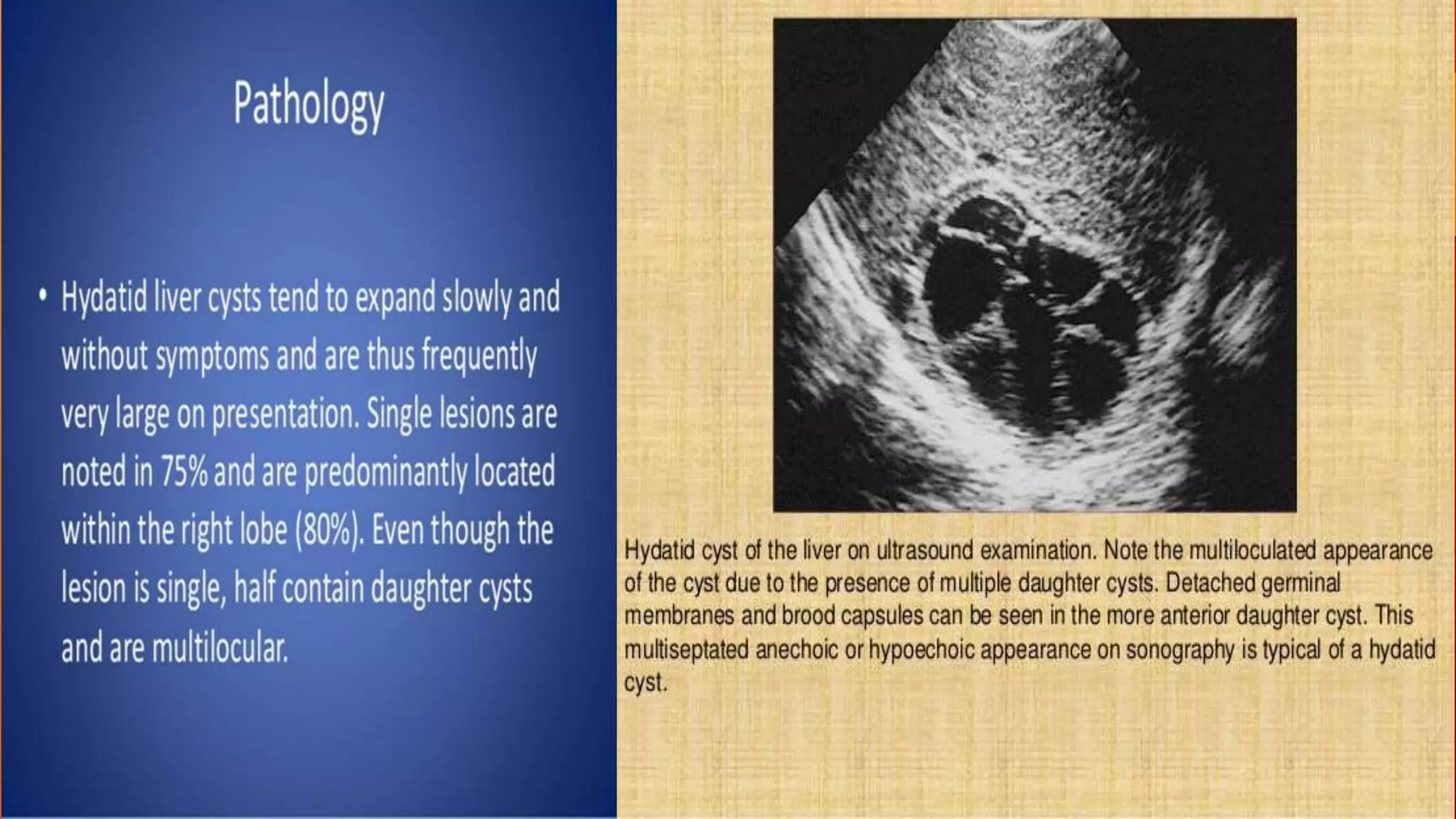 DIFFERENTIAL DIAGNOSIS OF SWELLINGS IN THE RIGHT HYPOCHONDRIUM AND ITS ...