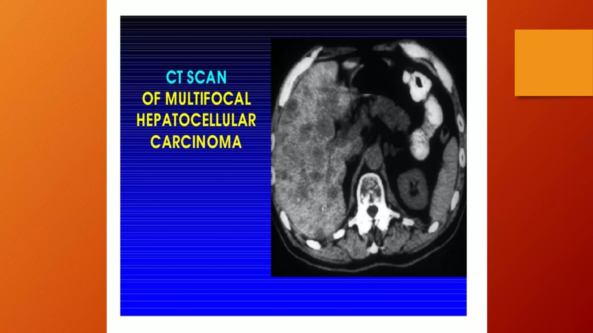 DIFFERENTIAL DIAGNOSIS OF SWELLINGS IN THE RIGHT HYPOCHONDRIUM AND ITS ...