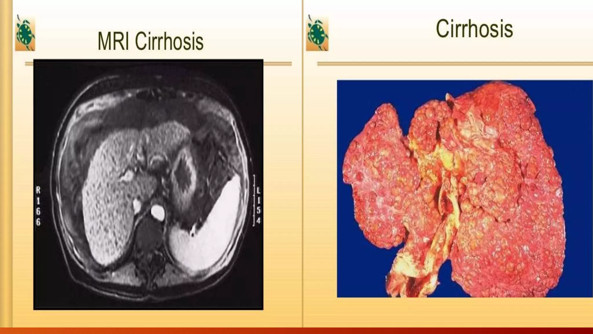 DIFFERENTIAL DIAGNOSIS OF SWELLINGS IN THE RIGHT HYPOCHONDRIUM AND ITS ...