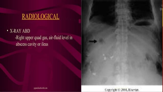 DIFFERENTIAL DIAGNOSIS OF SWELLINGS IN THE RIGHT HYPOCHONDRIUM AND ITS ...