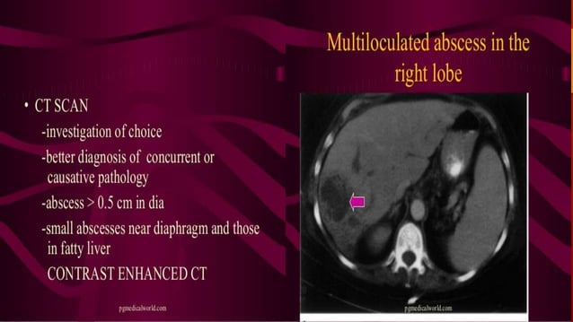 DIFFERENTIAL DIAGNOSIS OF SWELLINGS IN THE RIGHT HYPOCHONDRIUM AND ITS ...