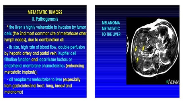 DIFFERENTIAL DIAGNOSIS OF SWELLINGS IN THE RIGHT HYPOCHONDRIUM AND ITS ...