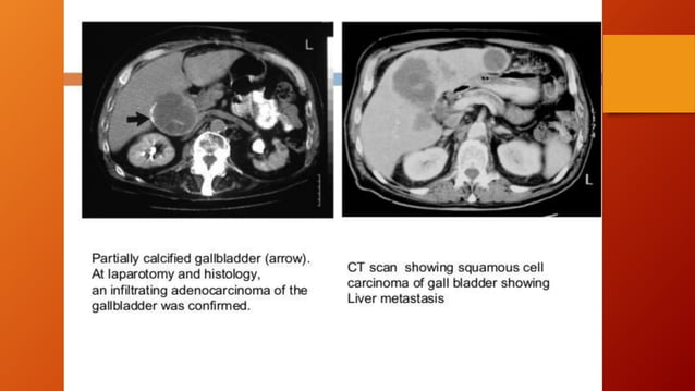 DIFFERENTIAL DIAGNOSIS OF SWELLINGS IN THE RIGHT HYPOCHONDRIUM AND ITS ...