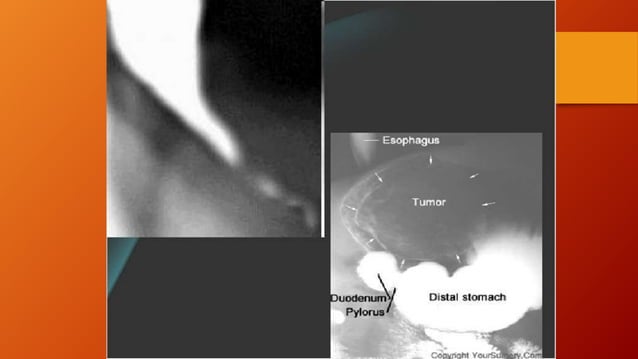 DIFFERENTIAL DIAGNOSIS OF SWELLINGS IN THE RIGHT HYPOCHONDRIUM AND ITS ...
