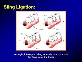 General Principles of Surgical Techniques for Periodontal Regeneration ...