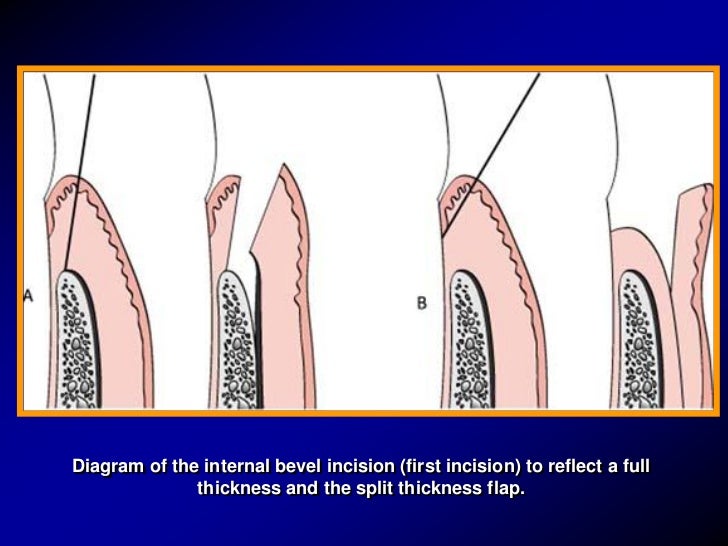 General Principles of Surgical Techniques for Periodontal Regeneration