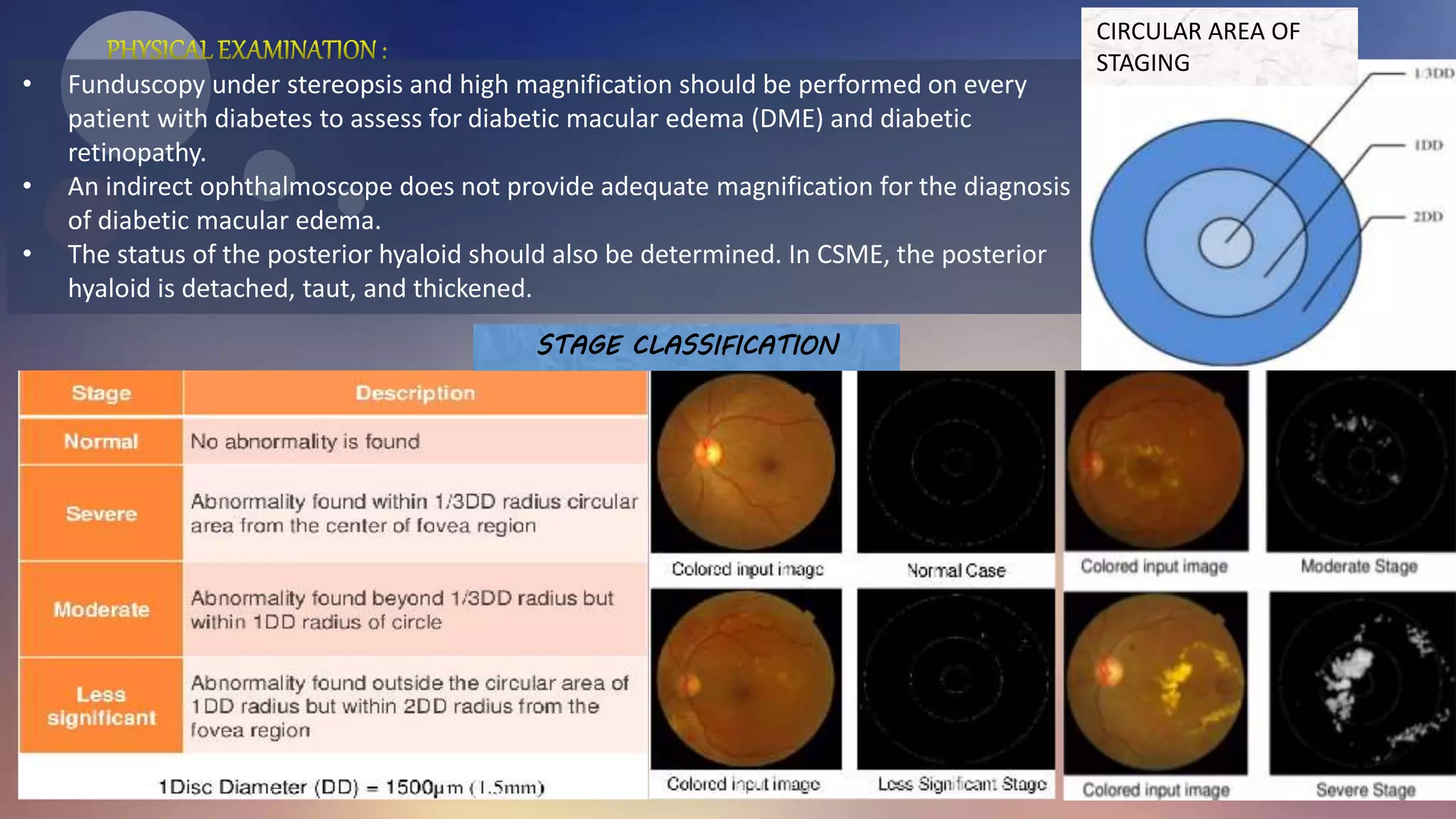 Diabetic Macular Edema (Surgery presentation) | PPTX