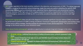 Diabetic Macular Edema (Surgery presentation) | PPTX