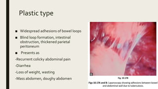 PERITONEAL TUBERCULOSIS & TUBERCULOUS MESENTERIC LYMPHADENITIS | PPTX