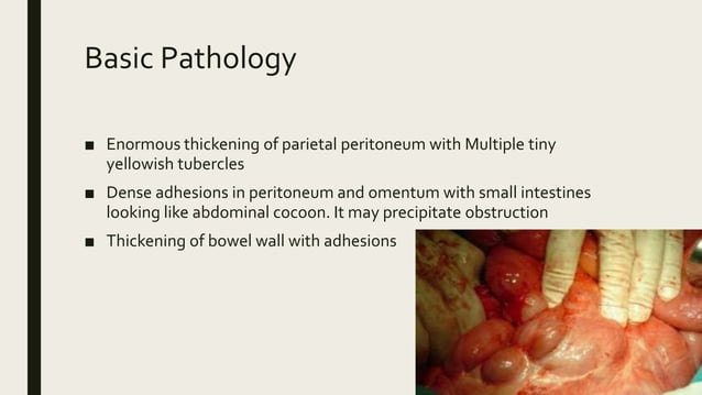 PERITONEAL TUBERCULOSIS & TUBERCULOUS MESENTERIC LYMPHADENITIS | PPTX
