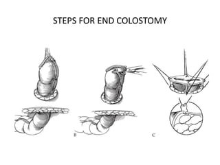 Surgery anorectum colon | PPTX