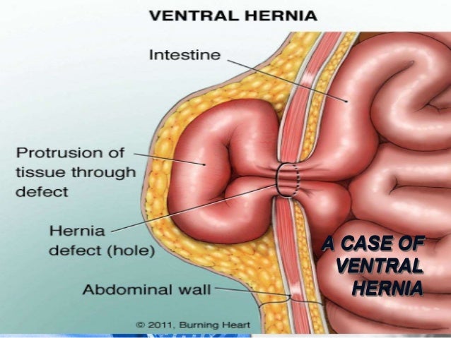 Surgery Case Presentation On Anterior Abdominal Wall Hernia 5378