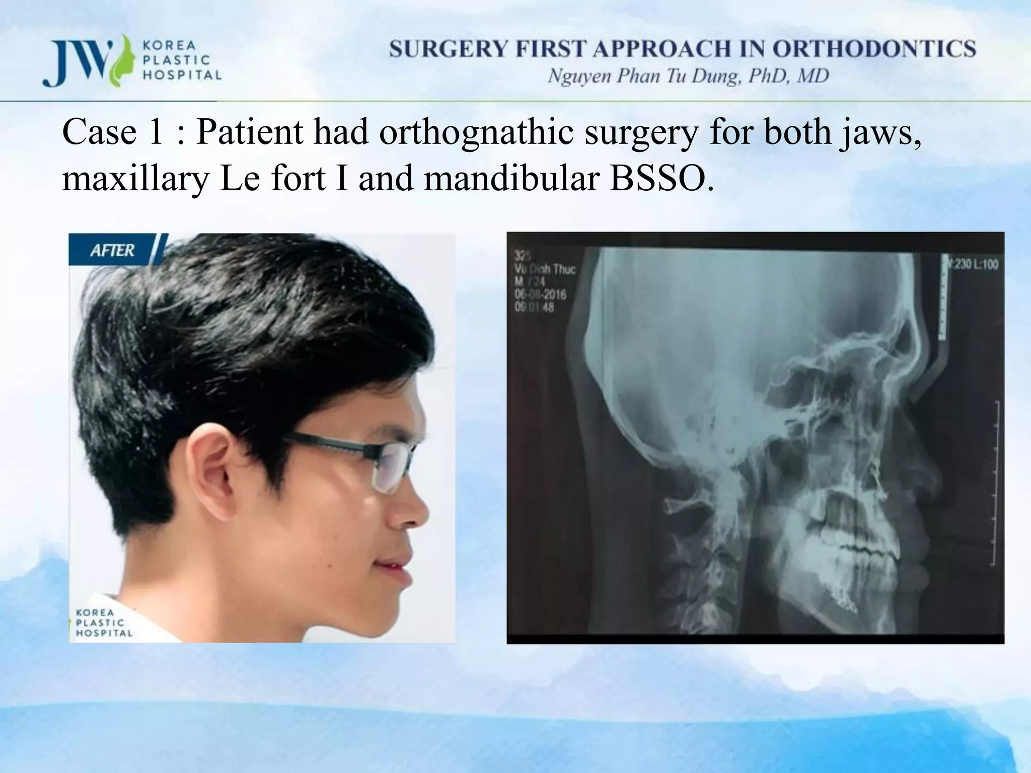 Surgery First Approach In Orthodontics | PDF