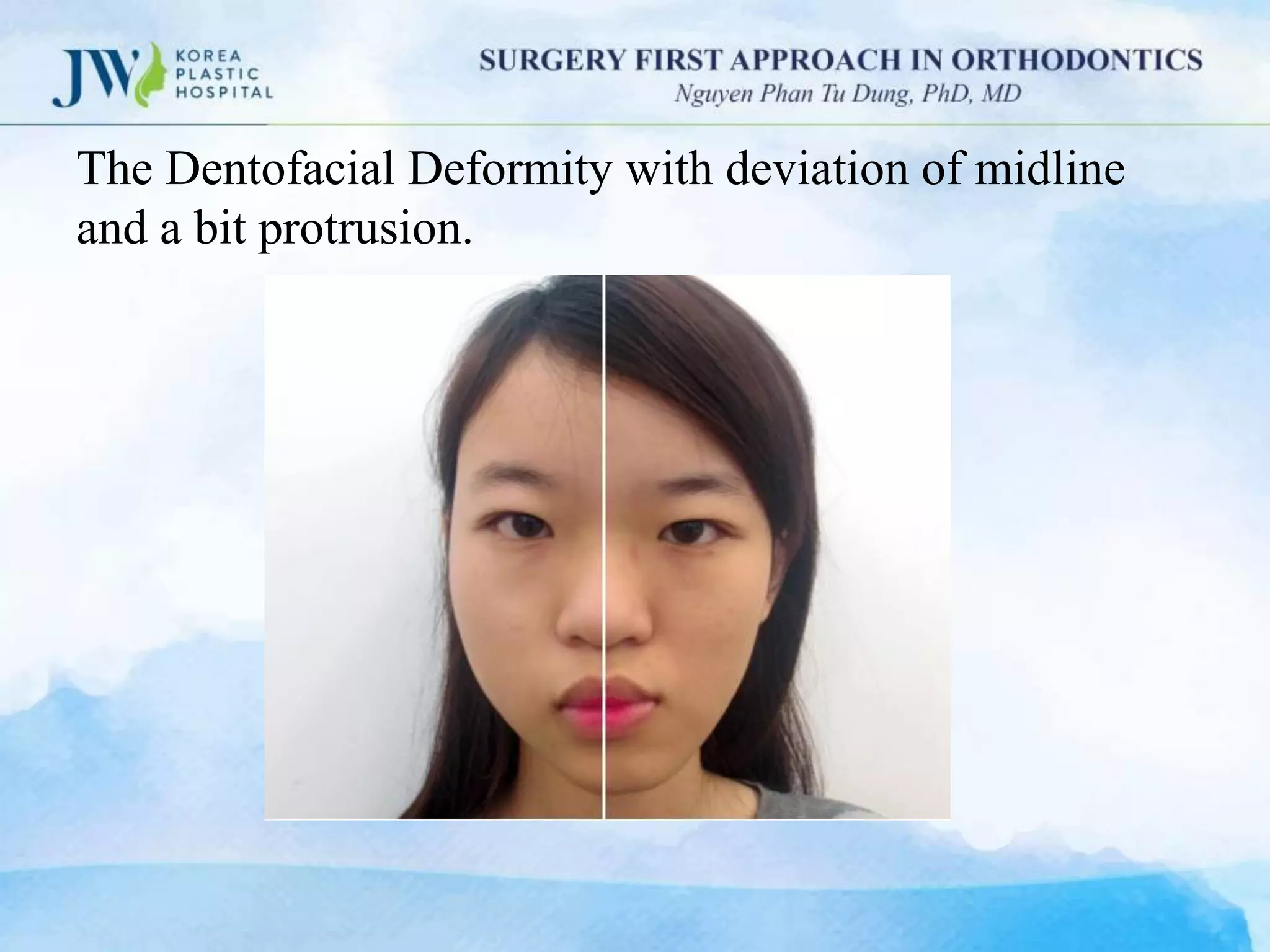 Surgery First Approach In Orthodontics | PDF