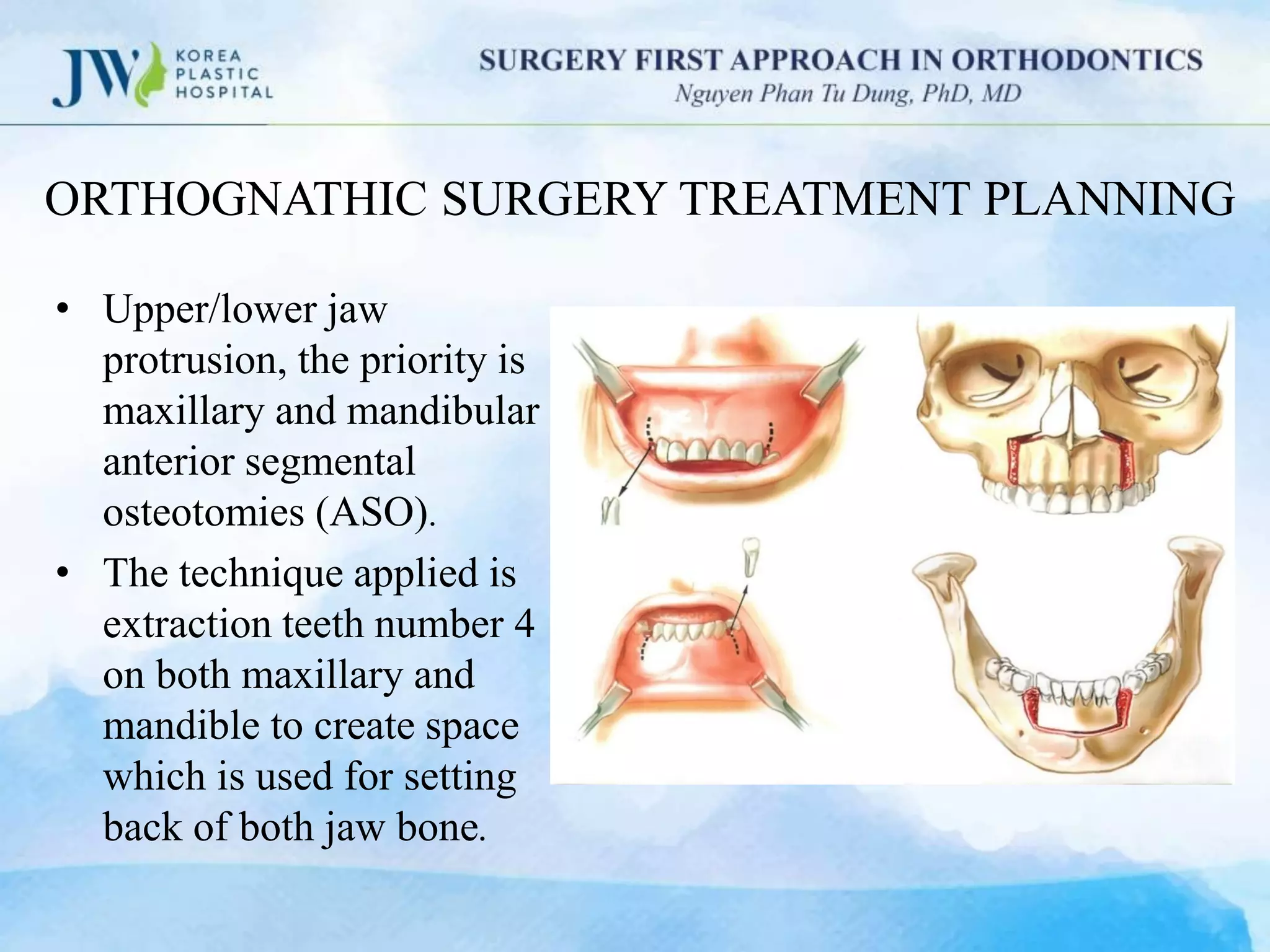 Surgery First Approach In Orthodontics | PDF