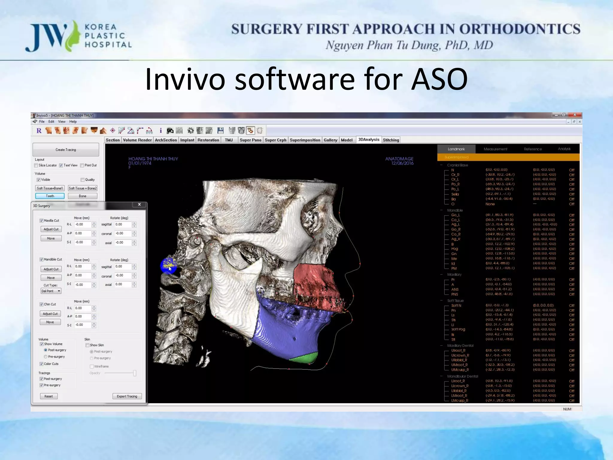 Surgery First Approach In Orthodontics | PDF
