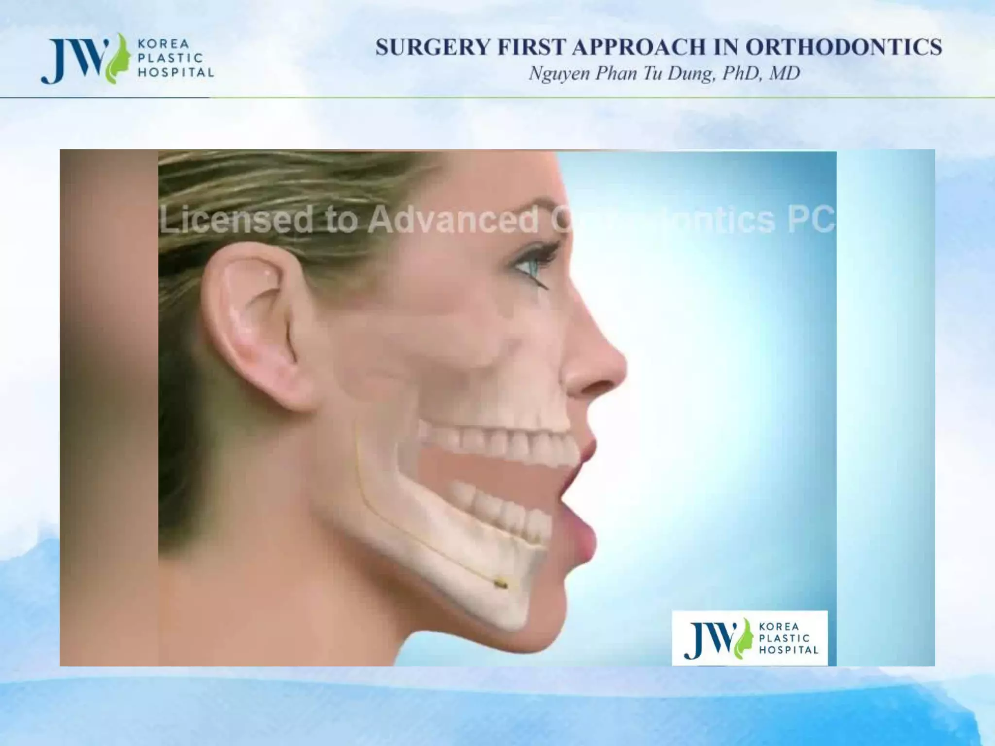 Surgery First Approach In Orthodontics | PDF