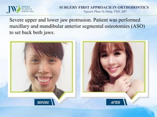 Surgery First Approach In Orthodontics | PDF
