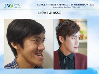 Surgery First Approach In Orthodontics | PDF