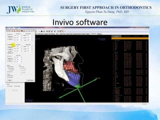 Surgery First Approach In Orthodontics | PDF