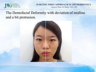 Surgery First Approach In Orthodontics | PDF