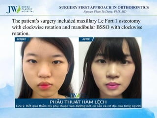 Surgery First Approach In Orthodontics | PDF