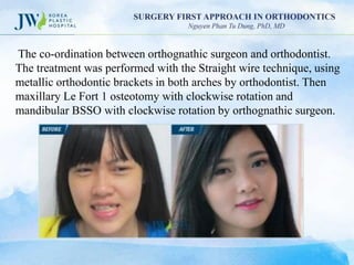 Surgery First Approach In Orthodontics | PDF