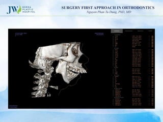 Surgery First Approach In Orthodontics | PDF