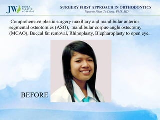 Surgery First Approach In Orthodontics | PDF