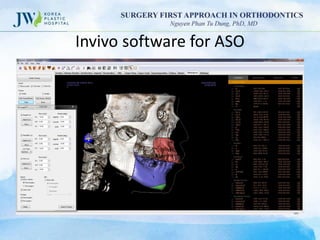 Surgery First Approach In Orthodontics | PDF