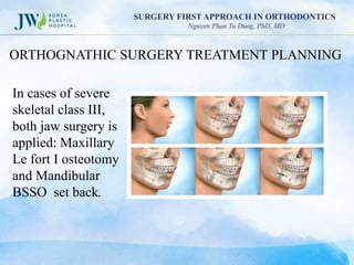 Surgery First Approach In Orthodontics | PDF