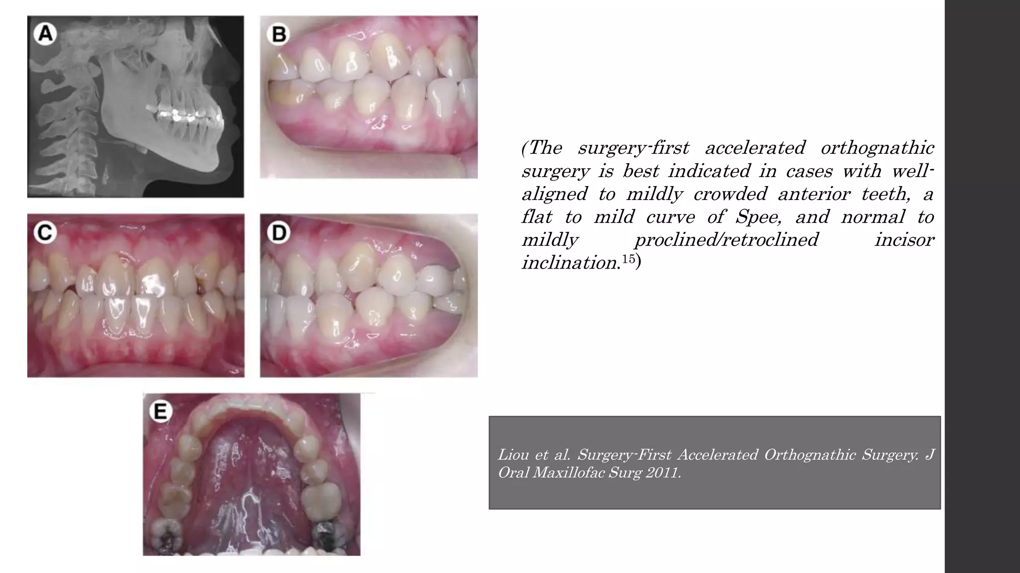 Surgery first orthognathic approach | PPTX