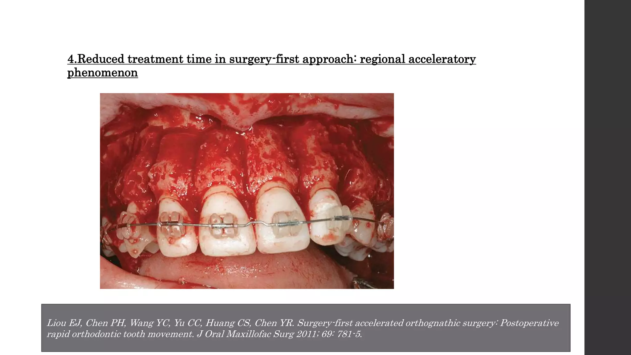 Surgery first orthognathic approach | PPTX
