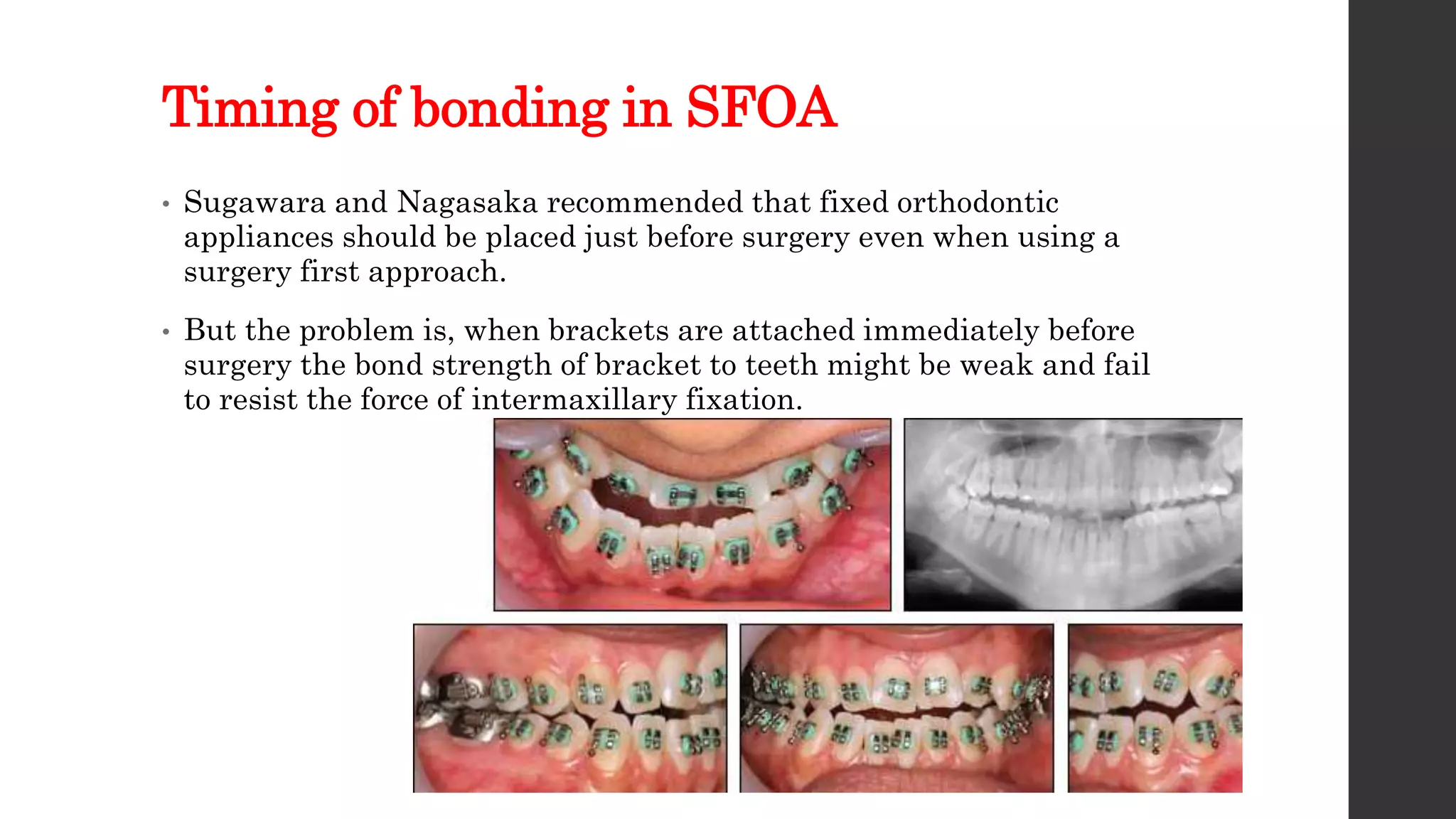 Surgery first orthognathic approach | PPTX