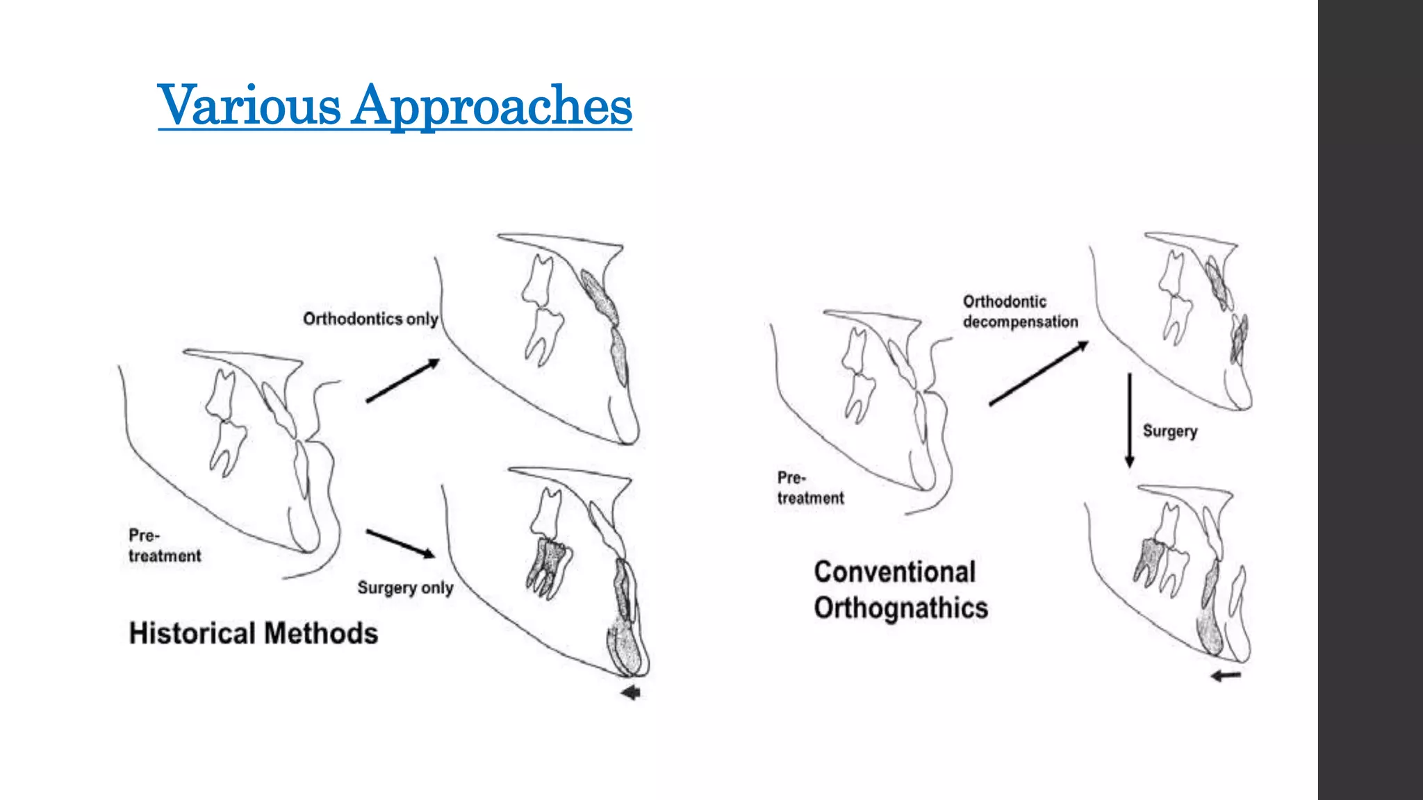 Surgery first orthognathic approach | PPTX