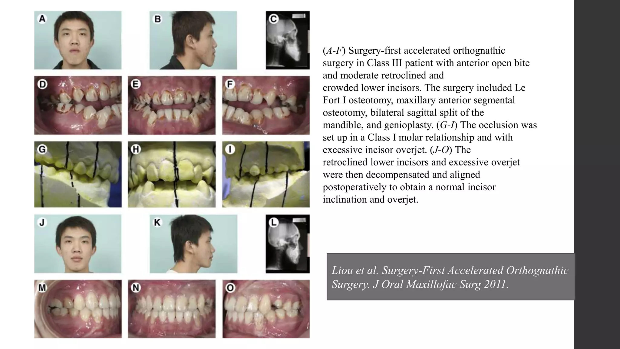 Surgery first orthognathic approach | PPTX