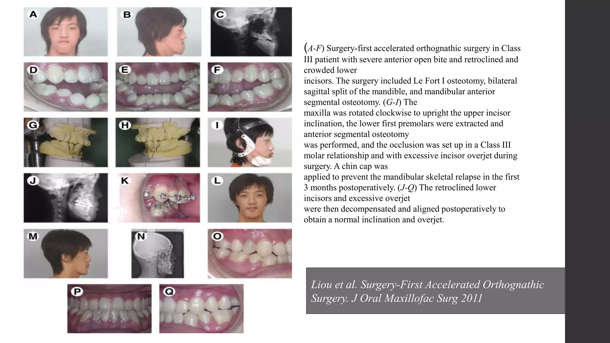 Surgery first orthognathic approach | PPTX